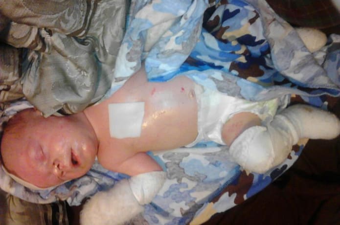 Help for Eli - a sweet baby battling Epidermolysis Bullosa | Indiegogo