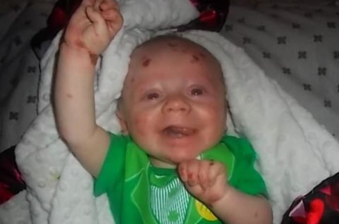 Help for Eli - a sweet baby battling Epidermolysis Bullosa | Indiegogo